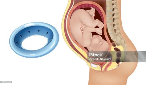 부인과 및 산부인과 페서리 자궁 경부가 짧은 임산부의 자궁 경부 페서리 조산 위험이 높은 여성에서 Arabin Cerclage Pessary의 효과적인 위치 모델링 자궁