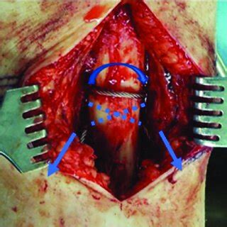 Intraoperative Image Demonstrating Cable Insertion Crossed Drilled Download Scientific Diagram