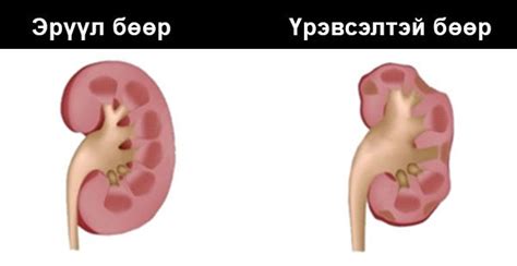 Бөөрний аяганцар тэвшинцрийн үрэвсэлт өвчин гэж юу вэ