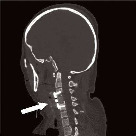 Post Mortem Computed Tomography Scanning Of The Cervical Spine
