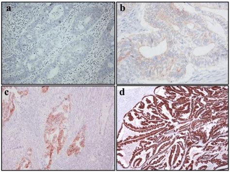 Ihc Scoring Of Her 2 Neu A 0 No Reactivity At 40x B 1 Barely Download Scientific Diagram