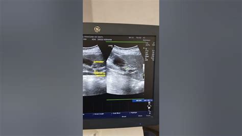 Periportal Lymphnode Ultrasound Youtube