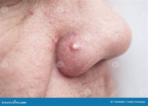 Closed Up Of Pimple Blackheads On The Nose Royalty Free Stock Image 49154788