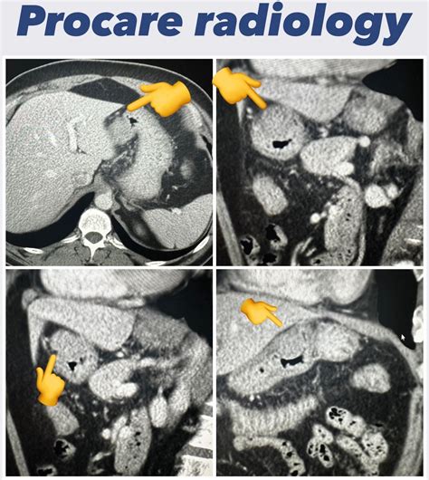 Frommyarchive Gastric Gist Adelmouradradiology Dradel Mourad