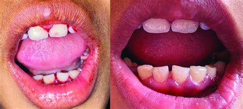 Patient 1 Intraoral View A Bleeding From Gingiva B After