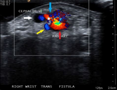 Arteriovenous Fistula Rare Complication Of Radial Artery Access Bmj