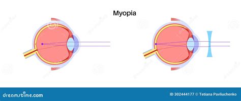 Normal Eye And Nearsightedness Stock Vector Illustration Of Human