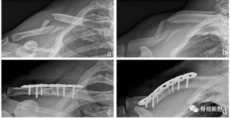 锁骨骨折手术有必要保留锁骨上神经吗？ 德医医学 助力医学教育发展！