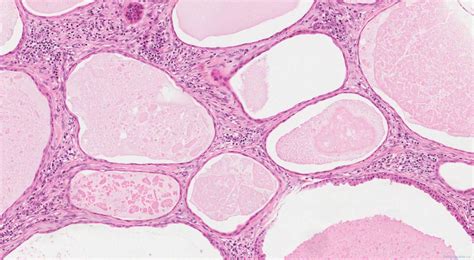 Intraductal Carcinoma Of The Salivary Glands Ottawa Atlas Of Pathology