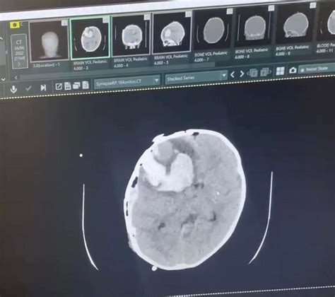 Hereditary Hemorrhagic Telangiectasia