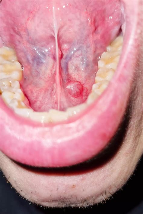 What Causes A Ranula Cyst Under The Tongue And How Is It Treated