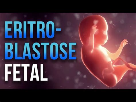 Eritroblastose Fetal Bebe Bryan Dyer Erythroblastosis Fetalis