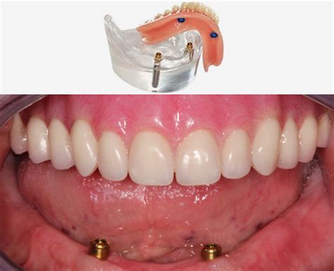 Locator Implant Overdenture Urs Toothfully