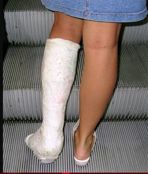 Slwc Short Leg Walking Cast Leg Cast Walking Cast Short Legs