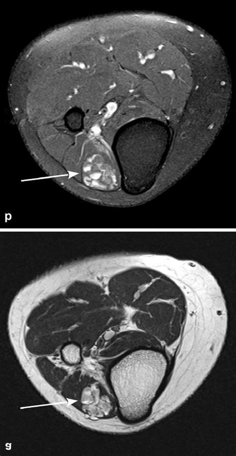 Hemangioma Mri