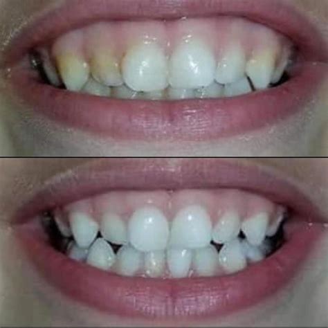 Whitenign Toothpaste Ap 24 Dental Cavities Whitening Toothpaste
