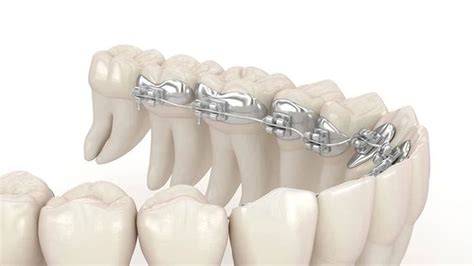 Lingual Braces Pros Cons Cost And Comfort