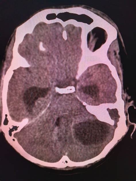Cerebellar Abscess Secondary To Chronic Mastoiditis In 2024 Radiology Imaging Radiology
