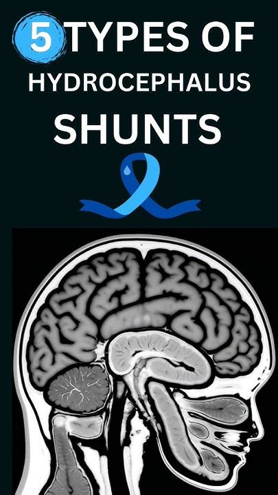 🧠 Types Of Hydrocephalus Shunts Youtube