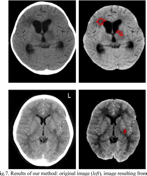 Figure From Segmentation Of Ischemic Stroke Area From CT Brain Images Semantic Scholar