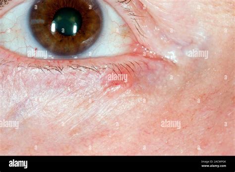 Close Up Of Basal Cell Carcinoma Bcc Or Rodent Ulcer On The Skin Of The Lower Eyelid In A 67