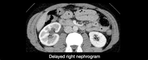 Abdominal Ct Renal Stones • Litfl • Radiology Library