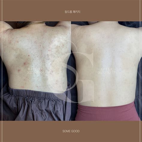 등드름•가드름•팔뚝 모공각화증•여드름흉터 관리 전문 부산 1등 부산광역시 부산진구 범천동 비즈프로필
