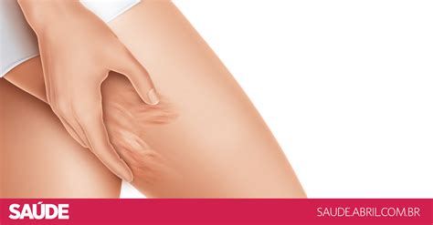 O Que é Celulite E Como Ela Surge Veja Saúde