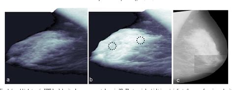 Figure 4 From A Mammographic Image Analysis Method To Detect And
