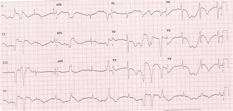 T Wave Inversions With A Difference BMJ Case Reports