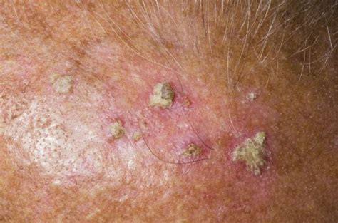 Image Actinic Keratosis On The Scalp Msd Manual Consumer Version