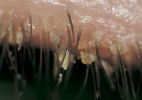 Blepharitis Scope Connect