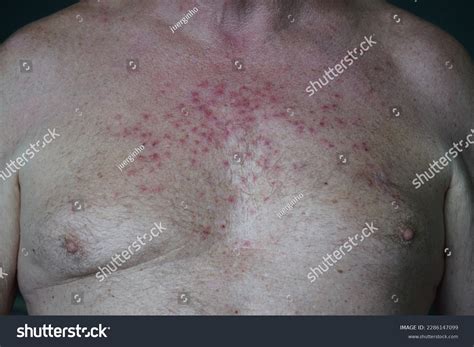 Scabies Rash On Chest