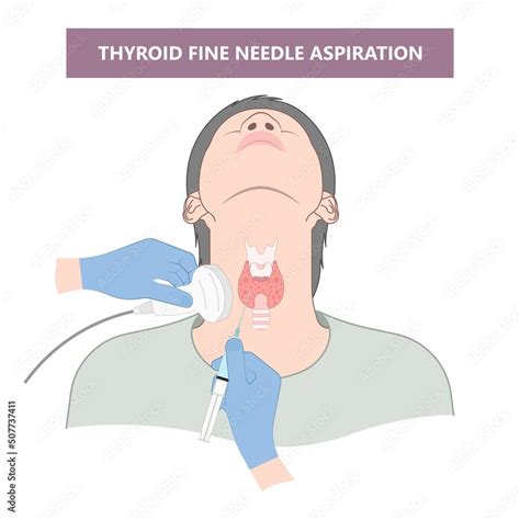 Thyroid Cancer Disease Nodules Ultrasound Screening Check Medical Treat