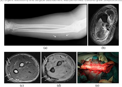 Figure 4 From Mri In Necrotizing Fasciitis Of The Extremities Semantic Scholar