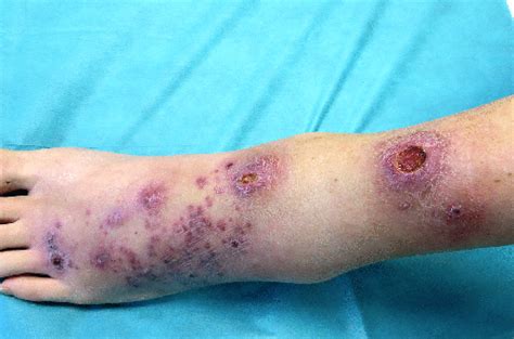 Mycobacterium Skin Lesions