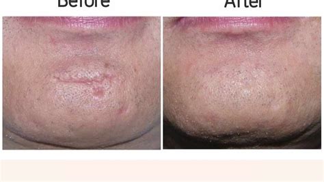 턱에 생긴 여드름켈로이드 각진 부분에 더 잘생긴다 원인이 무엇인지 꼭 확인하세요 네이버 Tv