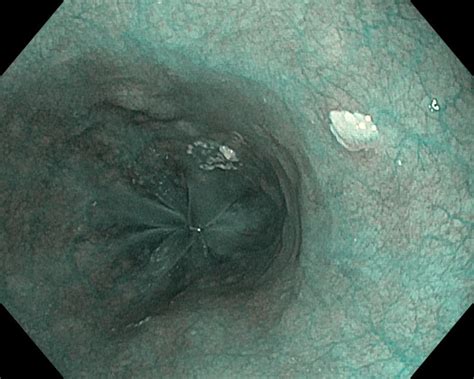 Keng Hoong Chiam On Linkedin Esophageal Squamous Papilloma