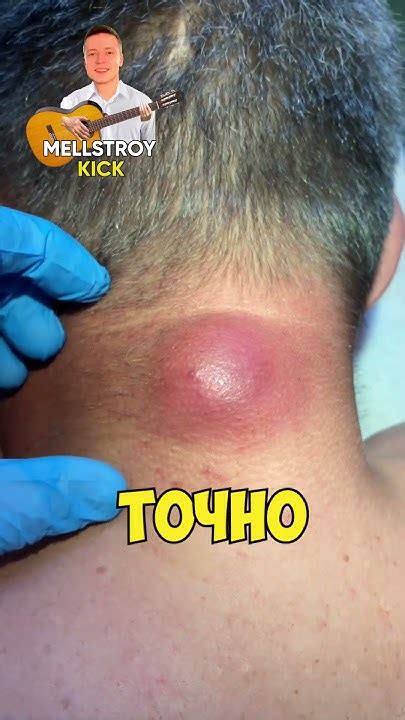 Шишка на шее Youtube