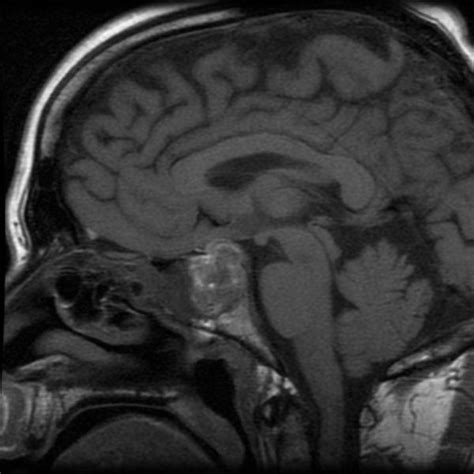 Pituitary Apoplexy Wikem