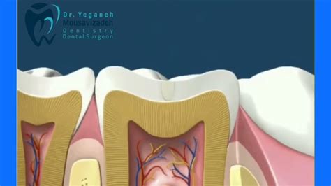 پوسیدگی دندان نماشا