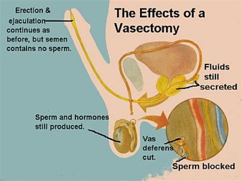 Vasectomy Clinic