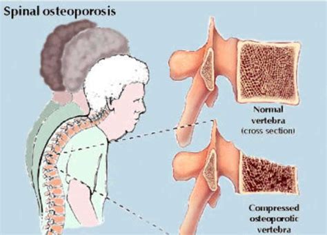 Schroth Method For Kyphosis Schroth Dc