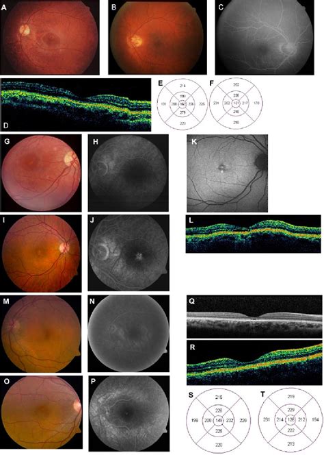 Figure 2 From Variable Retinal Phenotypes Caused By Mutations In The X