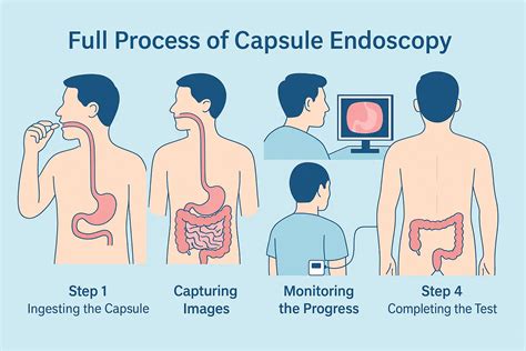 Capsule Endoscopy Melbourne Small Bowel Imaging