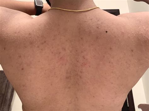 Acne Help With Back Acne Scars Rskincareaddiction