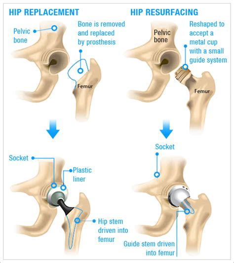 Hip Replacement Surgery Procedures Miot Hospitals