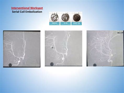 Endovascular Coil Embolization Of Dissecting Distal Mca Aneurysm With