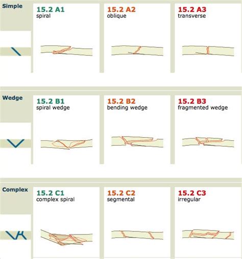 Clavicle Fracture Classification