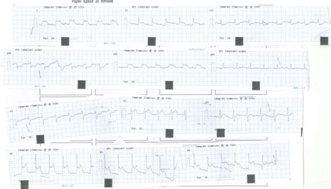 Ecg Showing Anterolateral Myocardial Infarction Download Scientific Diagram